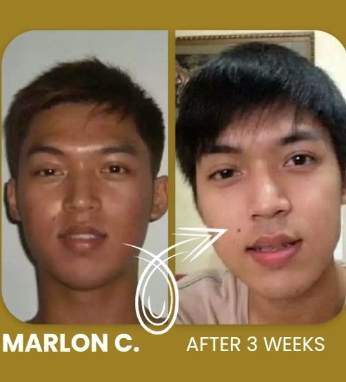 Ureshii Glutathione Bundle Offers – Ideal Beauty Deals